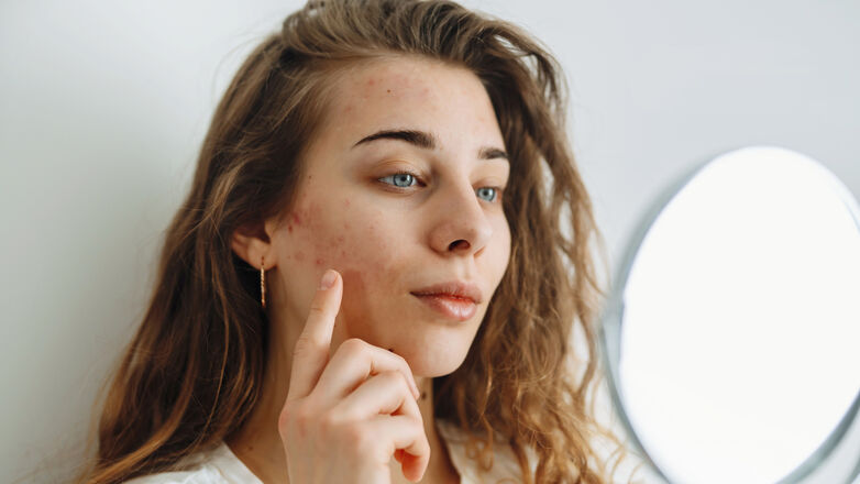 Dit is hoe je kunt zien of je acne hormonaal is - Trendalert